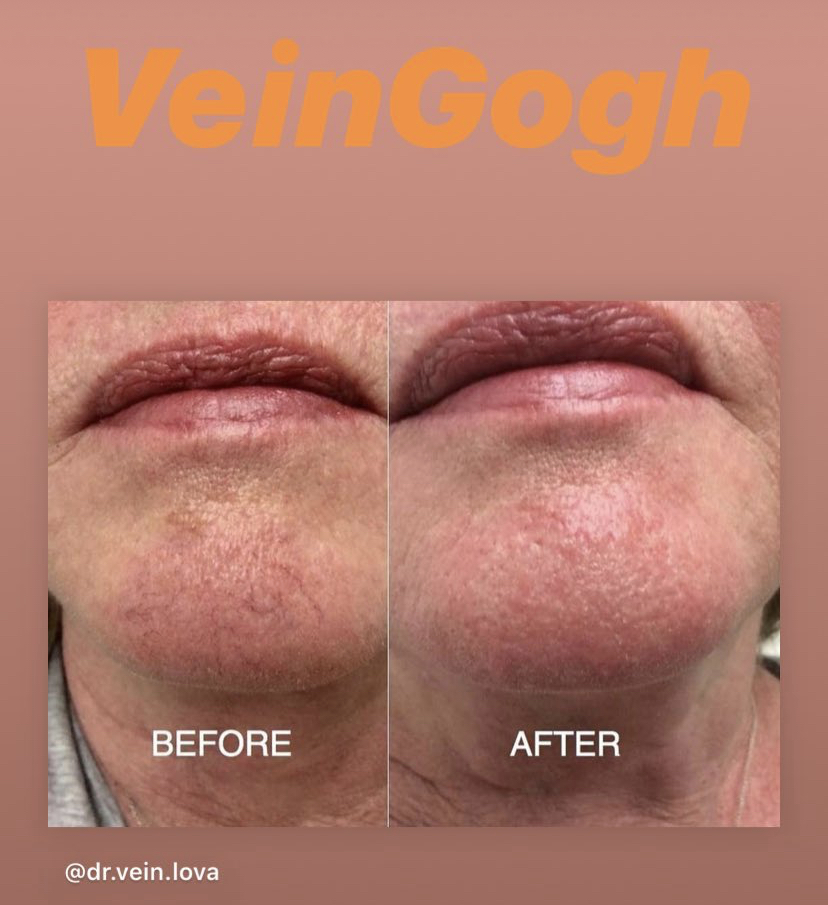 VeinGogh Spider Vein Treatments | Lake Oswego Vein & Aesthetic