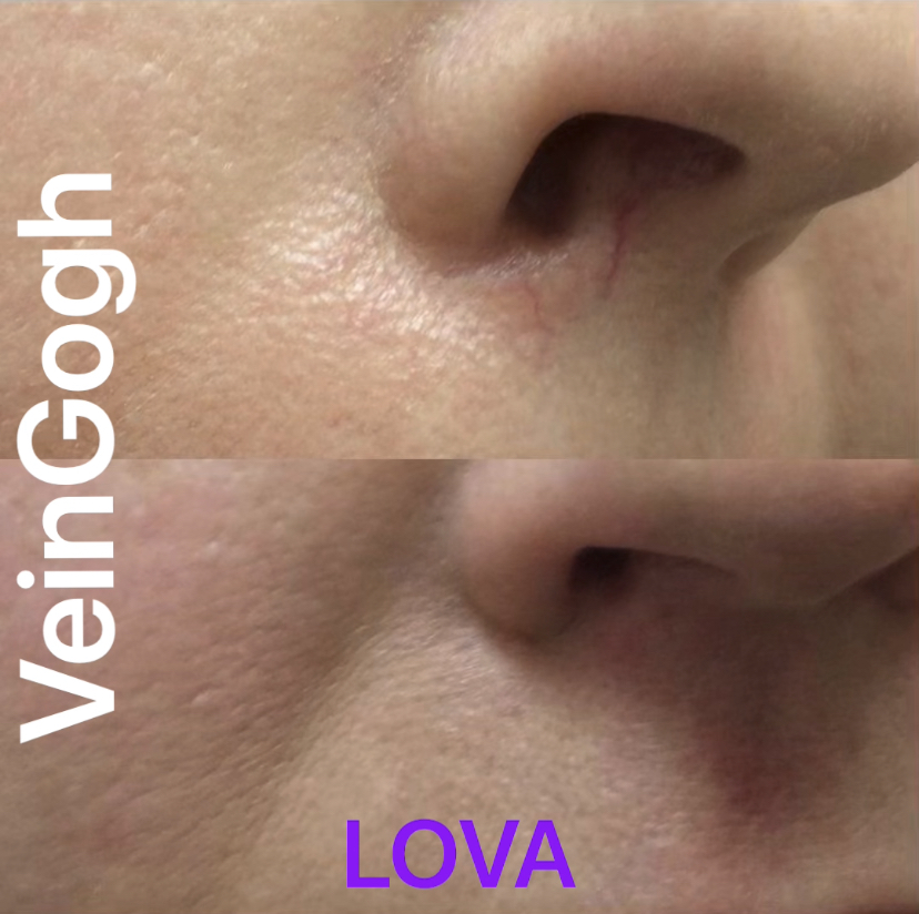 VeinGogh Spider Vein Treatments | Lake Oswego Vein & Aesthetic